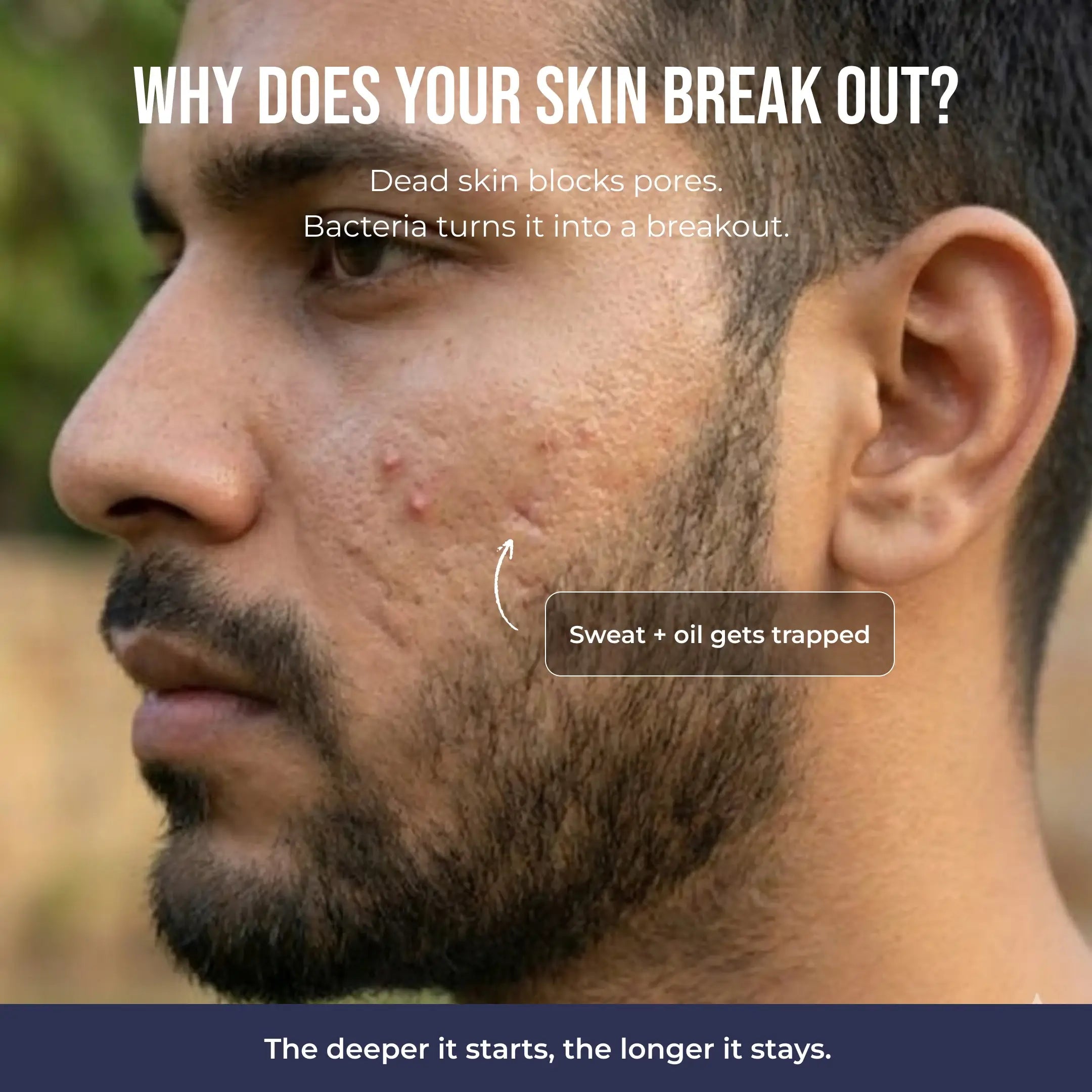 Acne Defense Mucin - TLPC – Yaan Man